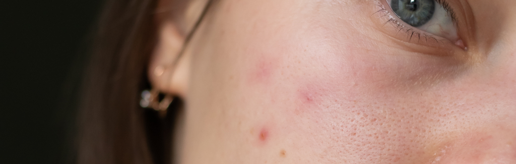 How does Alusil, the useful complex against acne, work?